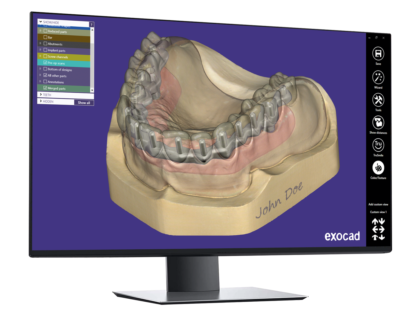 Exocad / DentalCAD / ChairsideCAD